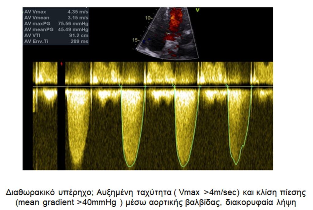 8.1α Στένωση Αορτής | Ελληνική Καρδιολογική Εταιρεία