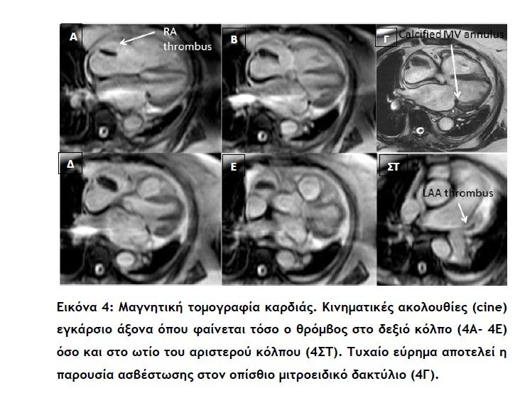 15.2 Θρόμβος δεξιού κόλπου | Ελληνική Καρδιολογική Εταιρεία